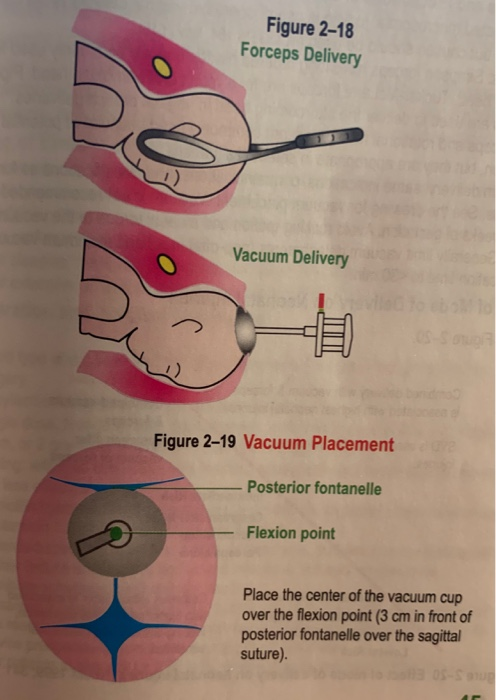 Forceps Delivery Scars