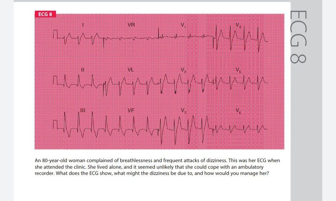 Solved ECG 8 VR V. herrar w We ECG 8 VL with nella parte | Chegg.com