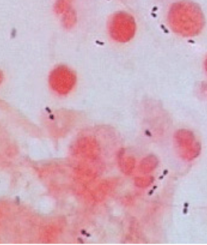 Solved You have one patient with the symptoms of meningitis. | Chegg.com