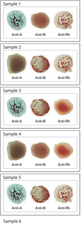Solved Blood sample Agglutination with Anti-A Serum | Chegg.com