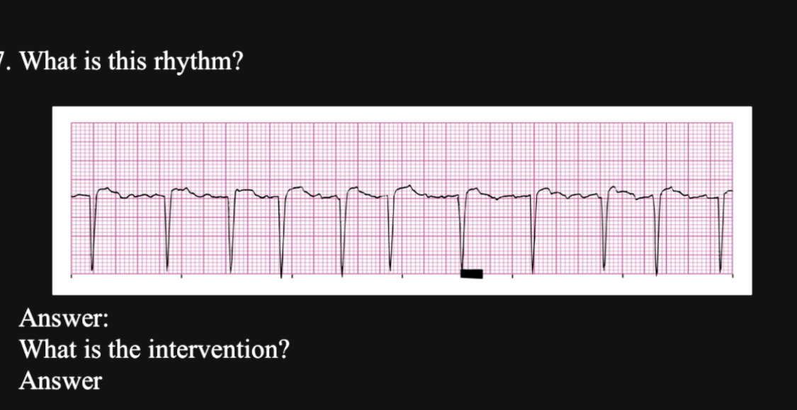 Solved What is this rhythm? Answer: What is the | Chegg.com
