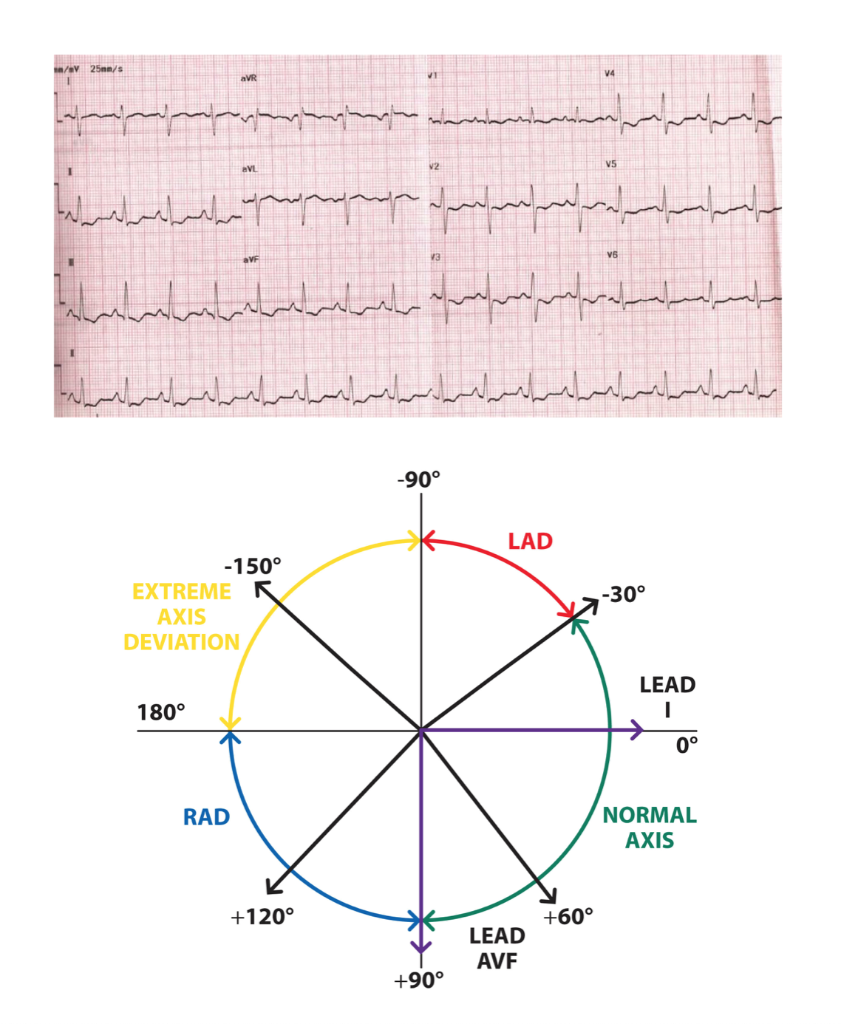 Solved Determine the Mean Electrical Axis represented by the | Chegg.com