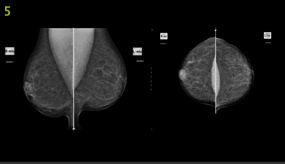 Mammography PGMI evaluation hi can i get help | Chegg.com