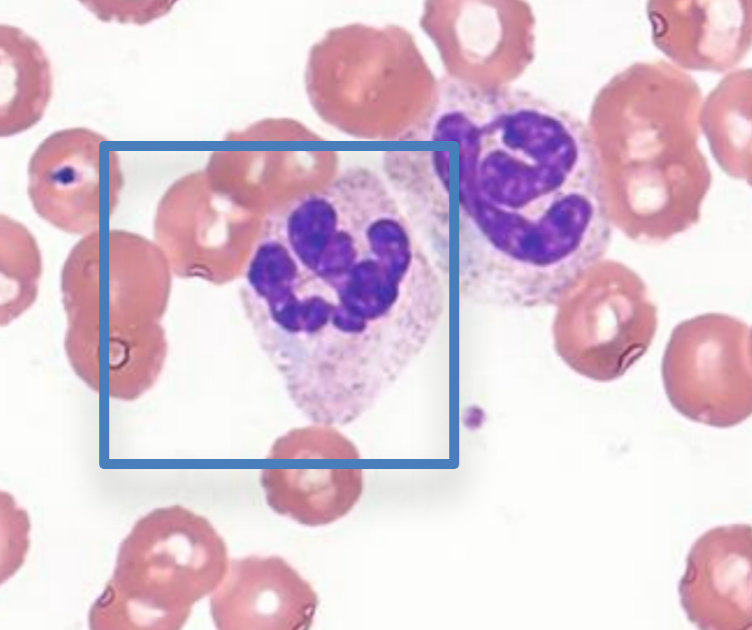 Solved How would a Hypersegmented Neutrophil cell be | Chegg.com