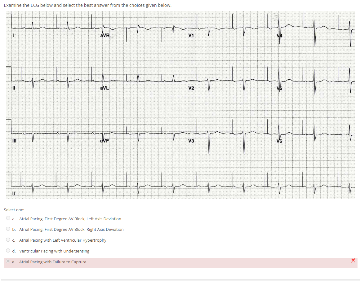 Solved Examine the ECG below and select the best answer from | Chegg.com
