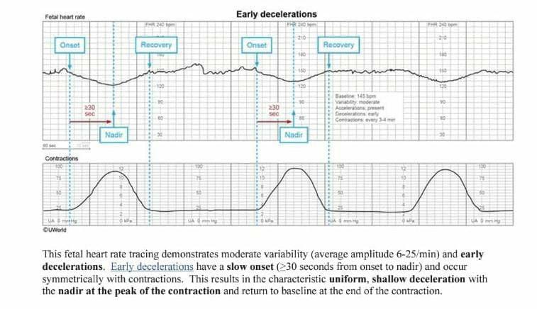 Solved Fetal heart rate Early decelerations THE 210 20 Onset | Chegg.com