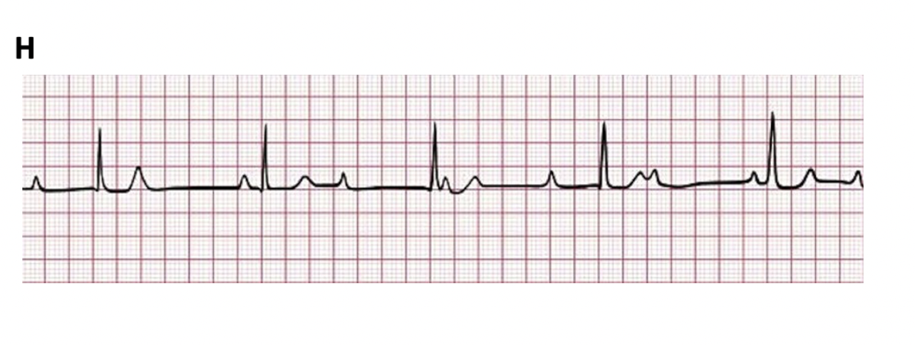 For each of the Lead II ECG traces of a resting heart | Chegg.com