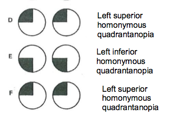 Superior Quadrantanopia