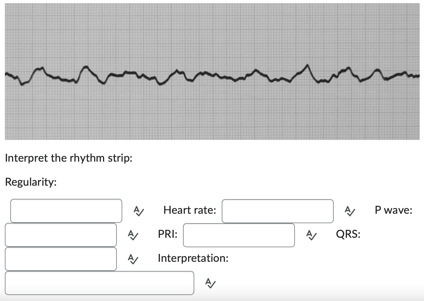 Solved Interpret the rhythm strip:Regularity:Heart rate:P | Chegg.com