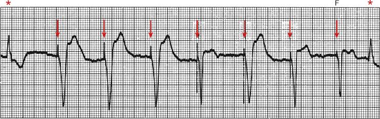 Solved Are the following pictures ECG pictures atrial or | Chegg.com