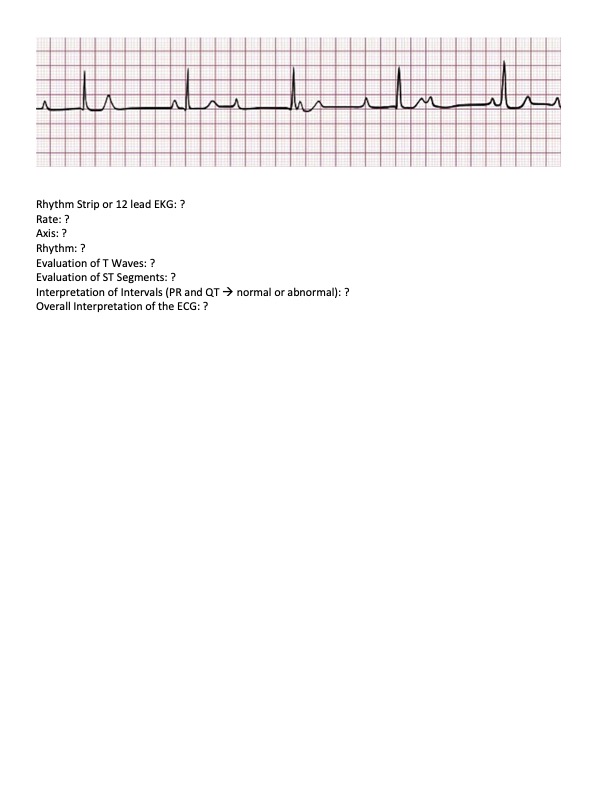 Solved Rhythm Strip or 12 ﻿lead EKG: ?Rate: ?Axis: ?Rhythm: | Chegg.com