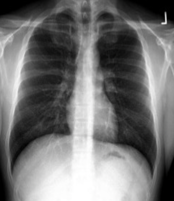 Interpret the above CXR. ( DRS.ABCDE) | Chegg.com