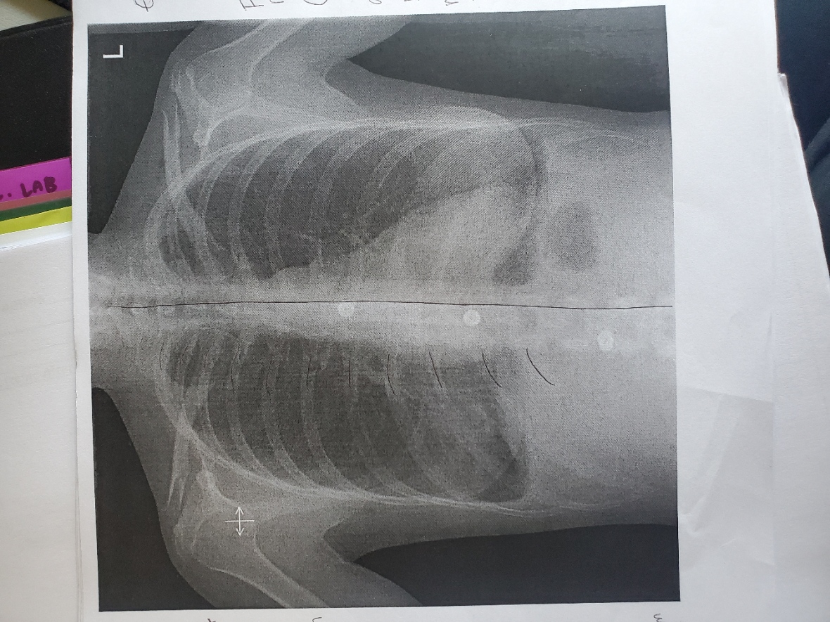 Solved 11- interpret this CXR and explain reasoning behind | Chegg.com