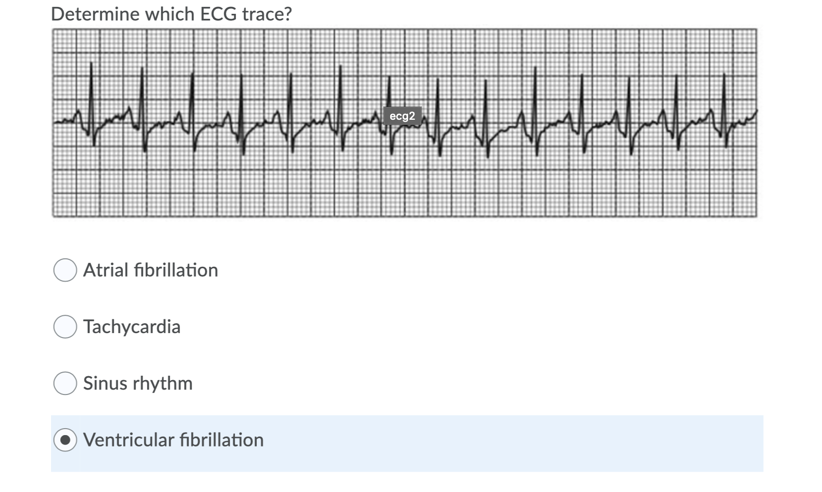 Solved Determine which ECG trace? ------ ecg2 www Atrial | Chegg.com