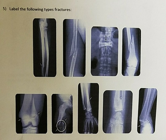 Solved 5) Label the following types fractures: When | Chegg.com