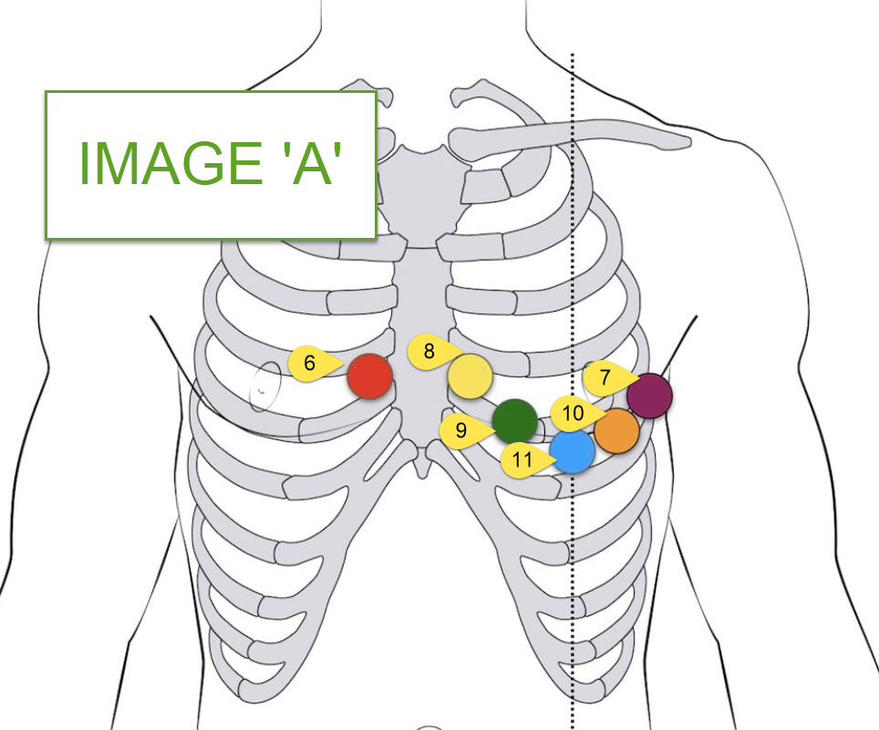 Solved The electrocardiogram electrodes are the devices that | Chegg.com