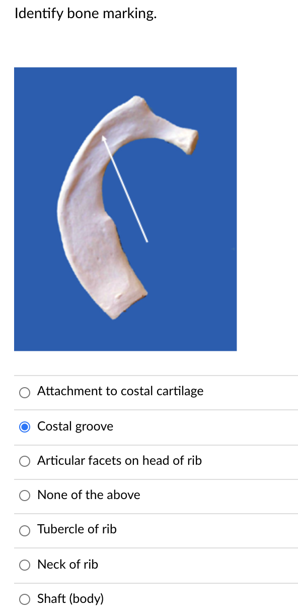 Solved Identify bone marking. O Posterior tubercle Lateral | Chegg.com
