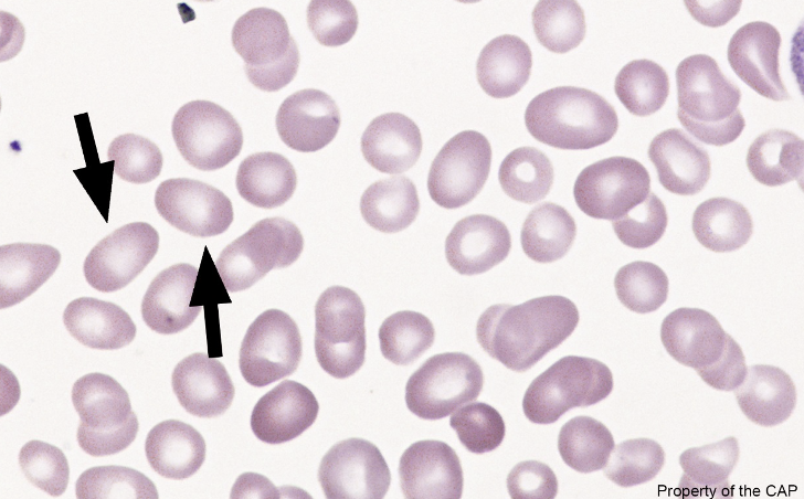Solved 45 year old female patient presented to the Emergency | Chegg.com