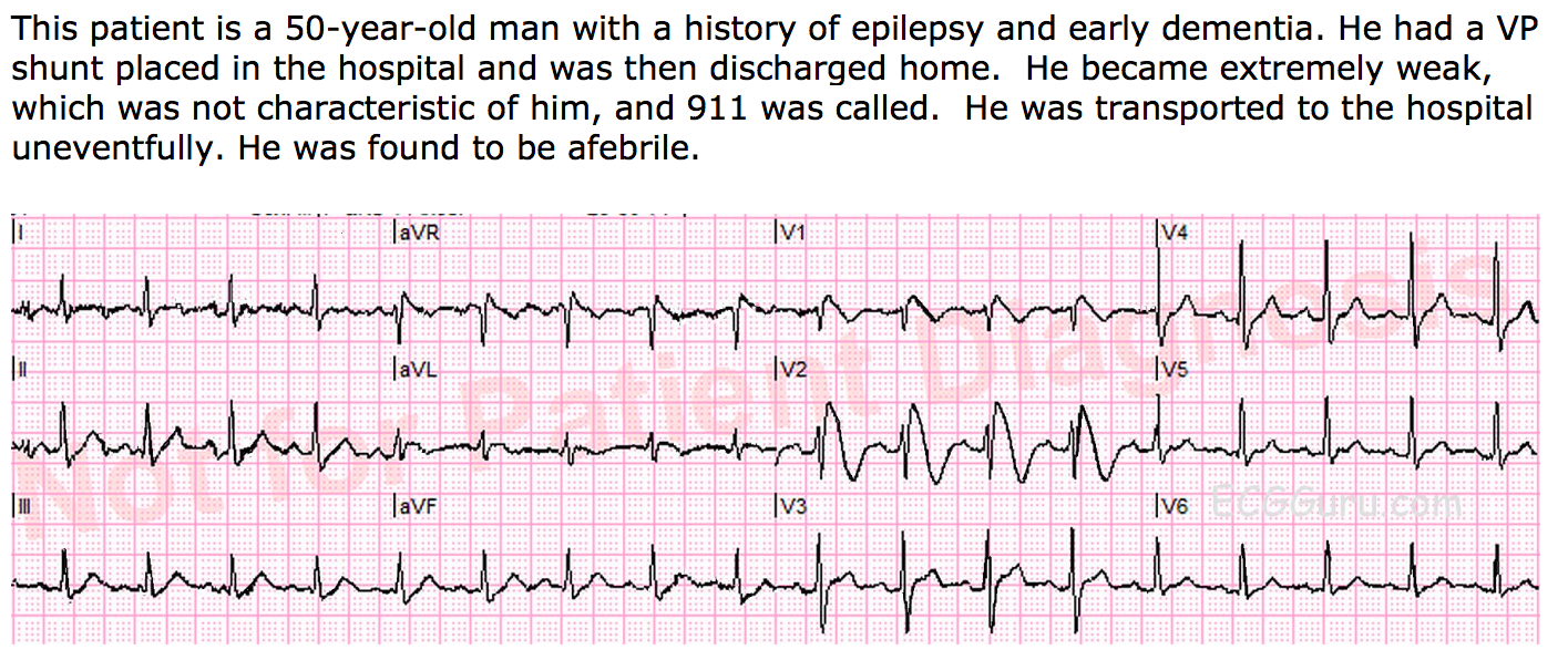 Solved MEASUREMENTS: PR Interval: QRS Interval: QT | Chegg.com
