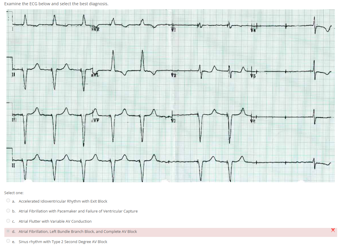 Solved Select one:a. ﻿Accelerated Idioventricular Rhythm | Chegg.com
