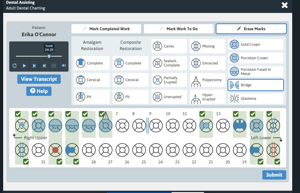 24 and 25 have had root canals and there is a lingual | Chegg.com