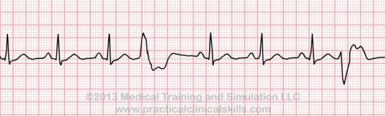 Solved Interpret this EKGa. ﻿Normal sinus rhythm with two | Chegg.com