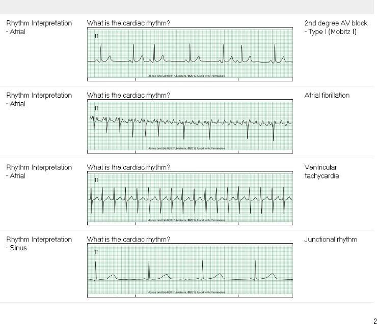 Ekg Rhythm Strips