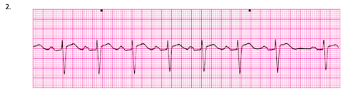 Solved Label the arrhythmia type on the EKG strip: (No | Chegg.com