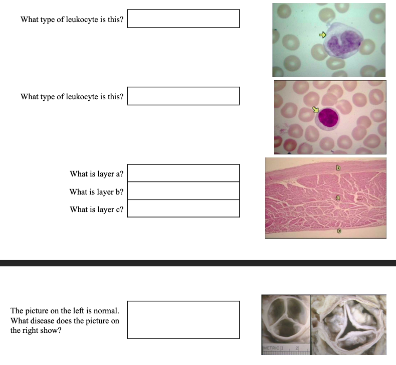 Solved What is MV? The picture on the left is normal. | Chegg.com