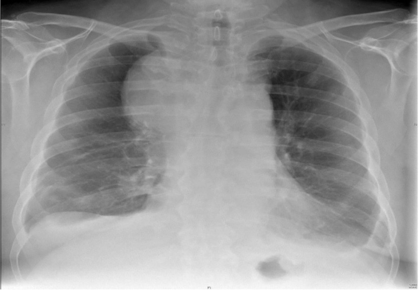 1- ﻿interpret this CXR and explain reasoning behind | Chegg.com