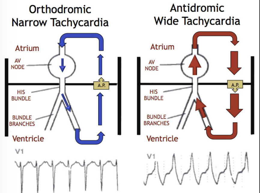 Antidromic Vs Orthodromic Cardiology