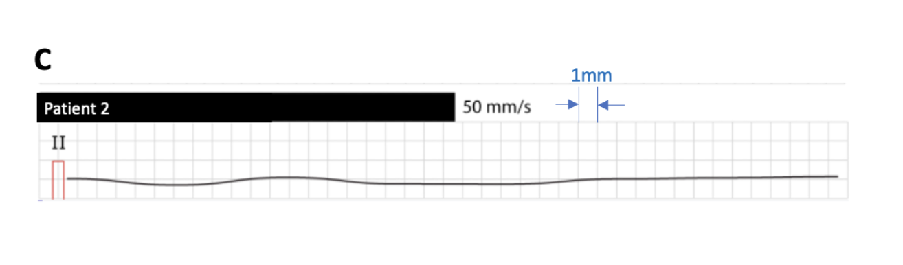 Solved For each of the Lead II ECG traces of a resting heart | Chegg.com