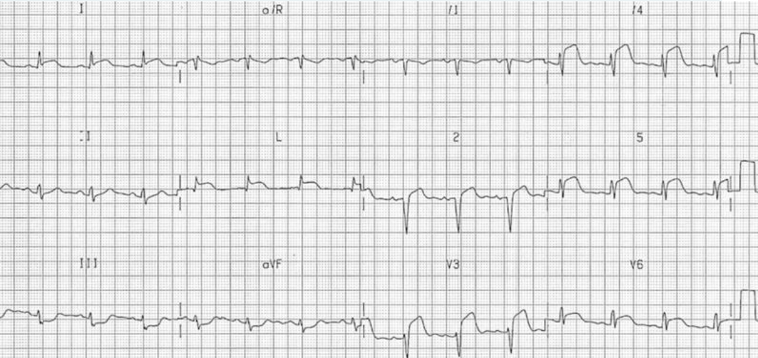 Solved Analyze ECG and choose the right diagnosis: a. | Chegg.com