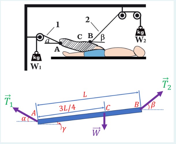 Solved The figure shows the Russel fracture traction device | Chegg.com