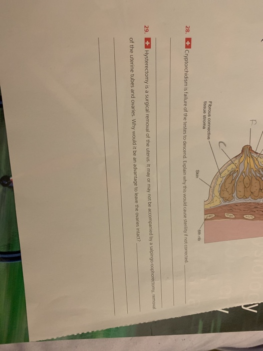 Solved connective tissue stroma 6th rib 28 Cryptorchidism is | Chegg.com