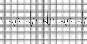 Solved The nurse is observing the electrocardiogram strip of | Chegg.com