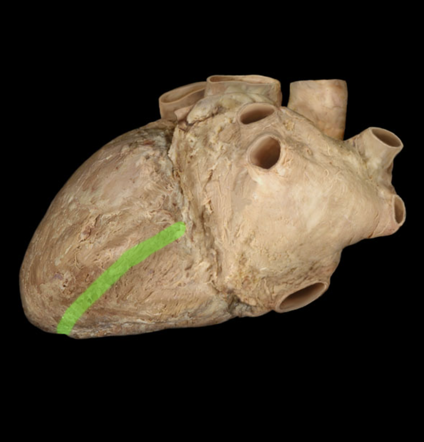 Coronary Sinus Cadaver