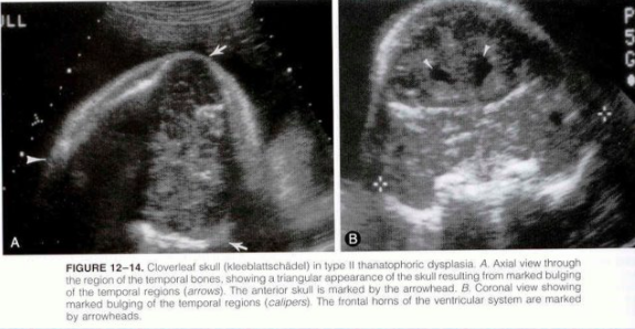 Cloverleaf Skull Ultrasound
