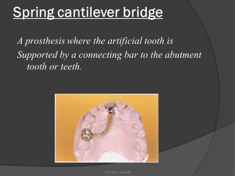 Spring Cantilever Bridge Dental