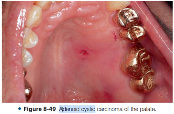 Adenoid Cystic Carcinoma Palate