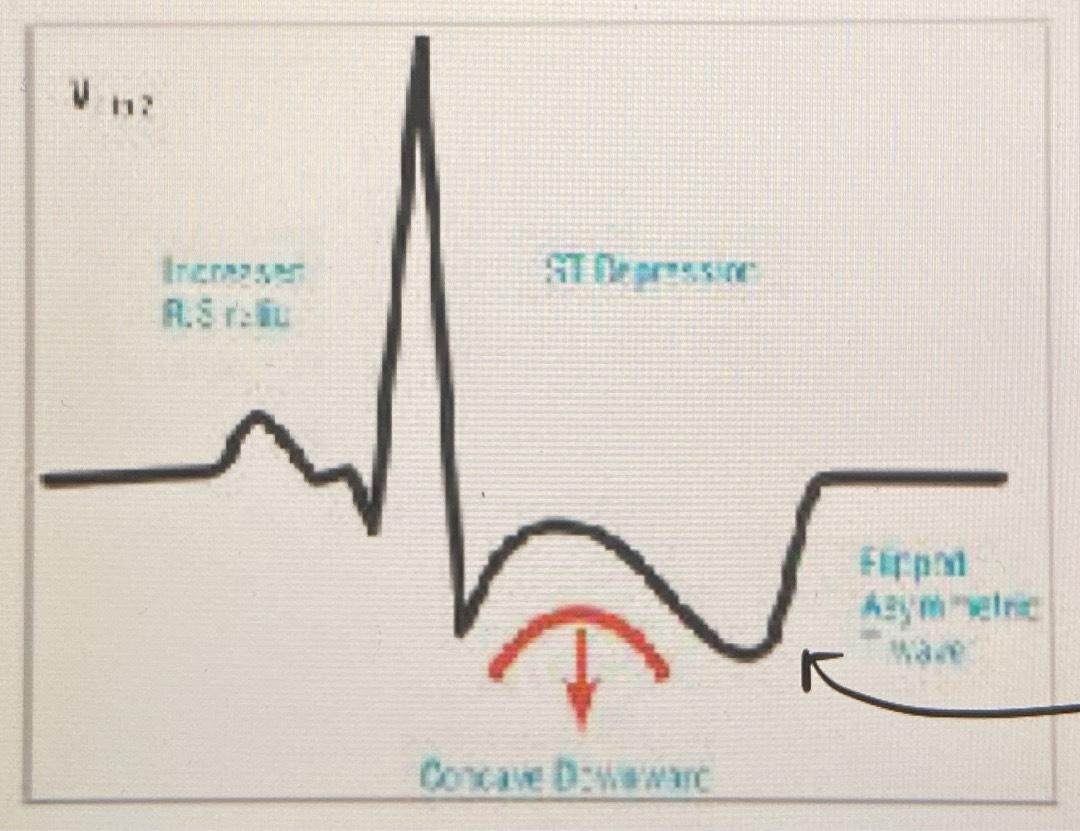 Concave Vs Convex Ecg