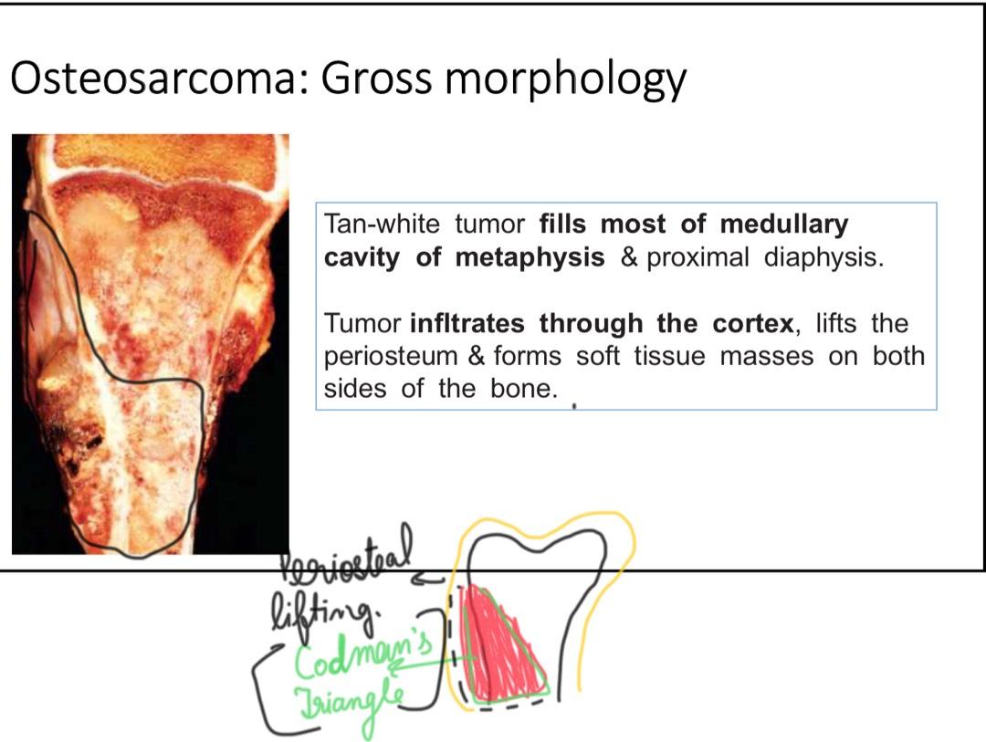 Osteosarcoma Gross