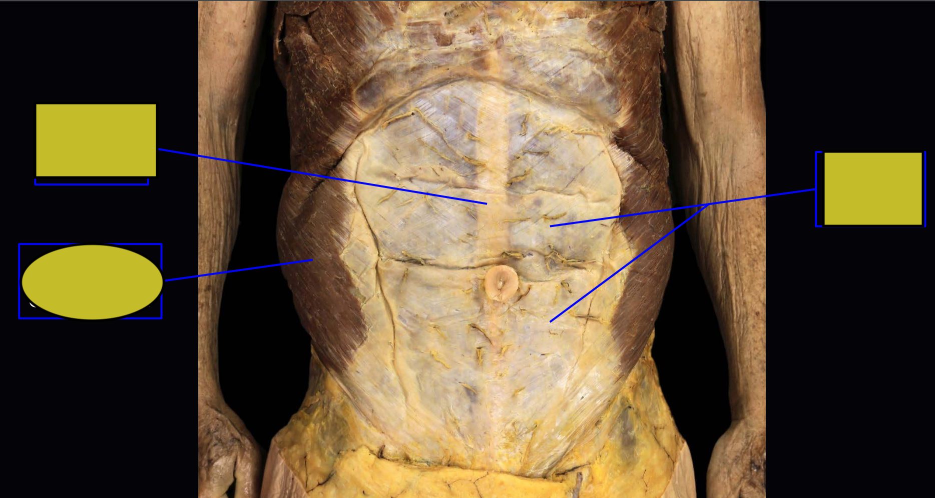 Arcuate Line Cadaver
