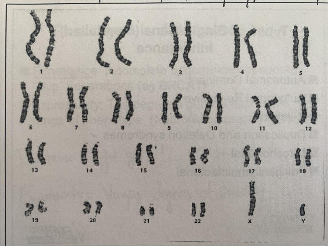 Msud Karyotype Abnormal Male