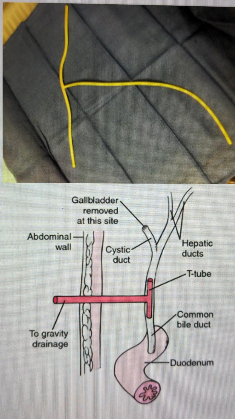 T Tube Drain Removal
