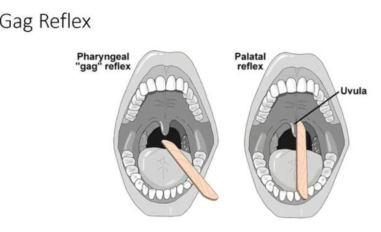 Gag Reflex Test