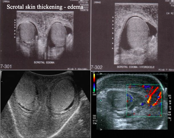 Scrotal Edema