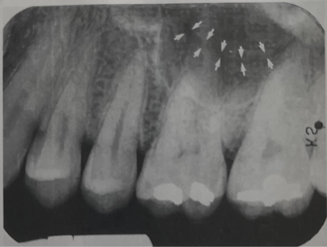 Nutrient Canal Radiograph