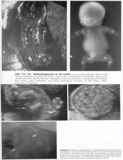 Achondrogenesis Ultrasound