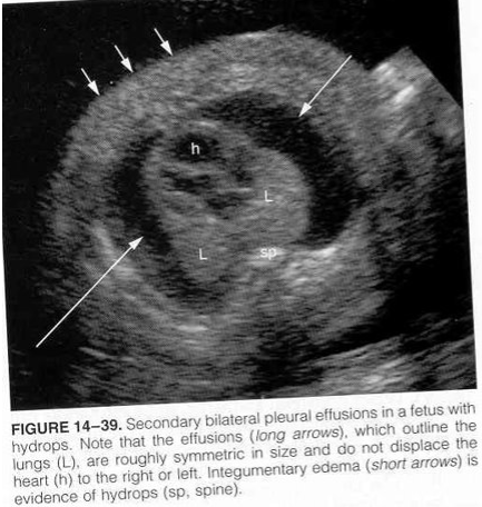 Pleural Effusion Fetal Ultrasound